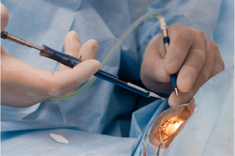 Cataract Surgery Timeline: From Evaluation to Clear Vision in Los ...
